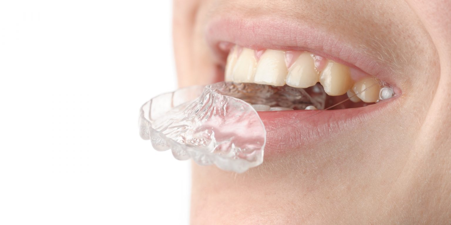Zahnschiene: Viele Einsatzgebiete? - Team Dental
