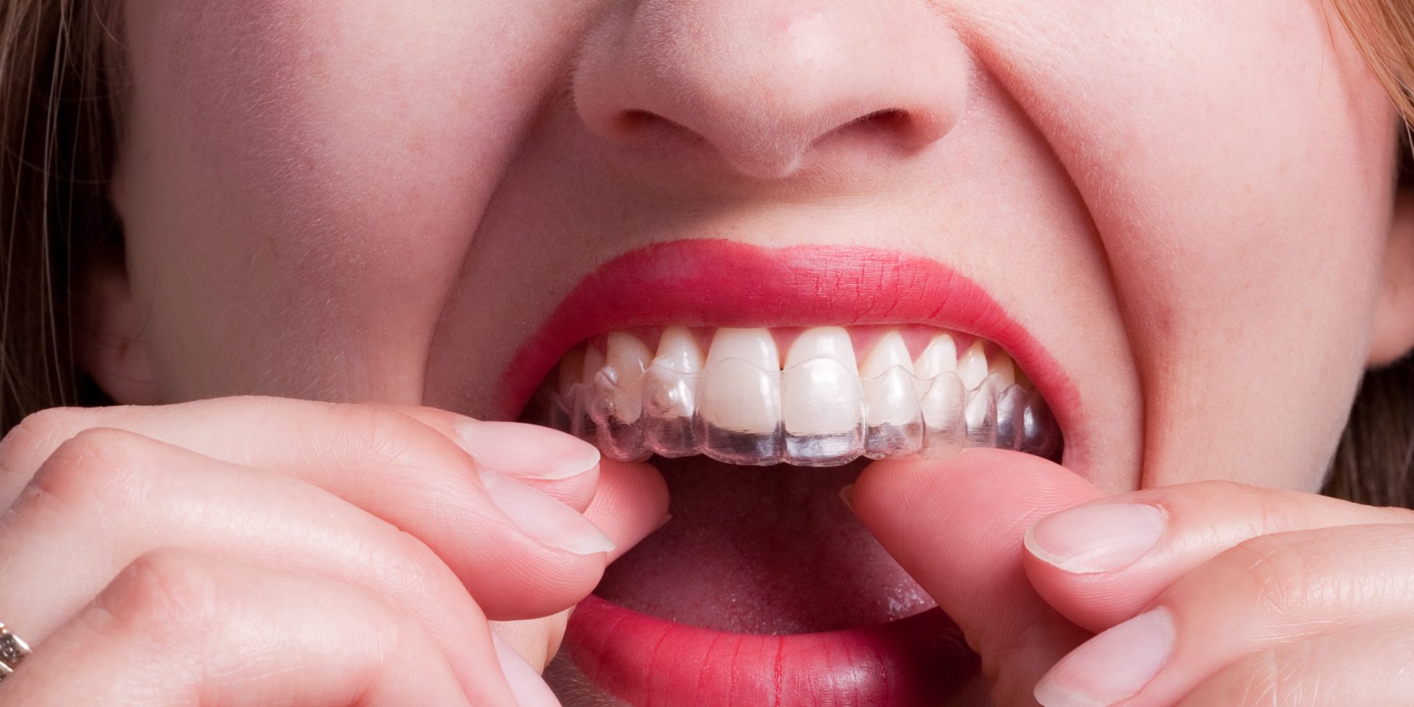 Zahnschiene: Viele Einsatzgebiete? - Team Dental